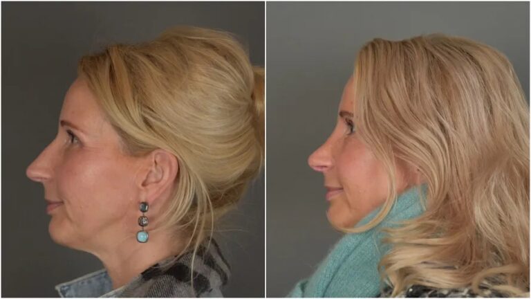 Neuscorrectie Limburg: 10 vragen over een neuscorrectie | Limburg ...