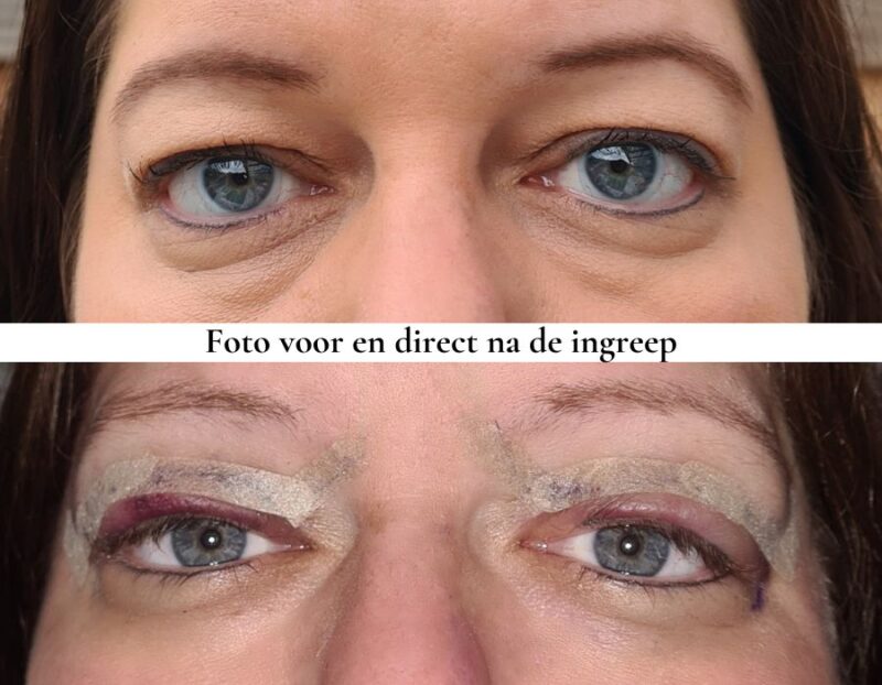 Genezingsproces ooglidcorrectie per dag: Ervaring Kim + Foto’s