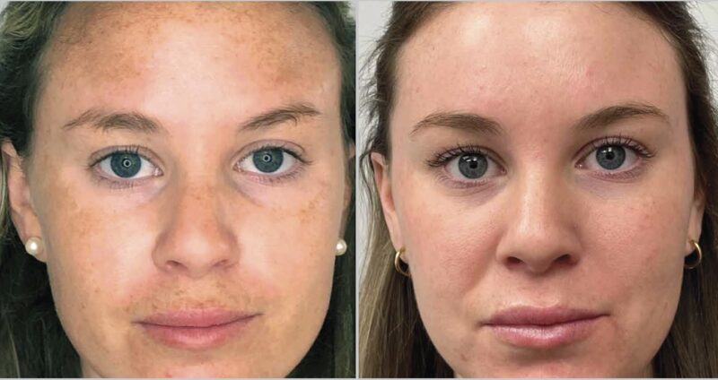 Laserbehandeling gezicht en lichaam | - Mooi Kliniek